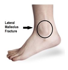 Weber B fracture · Virtual Fracture Clinic