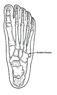 Base of 5th metatarsal fracture · Virtual Fracture Clinic